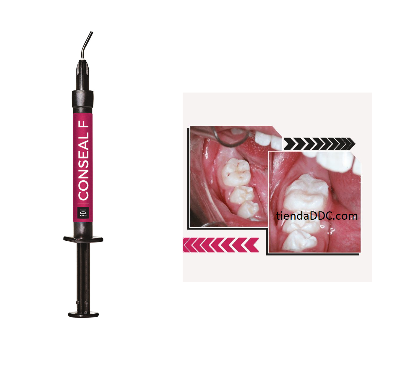 Conseal F Sellador Dental De Fosetas Y Fisuras Sdi 1gr | SDI