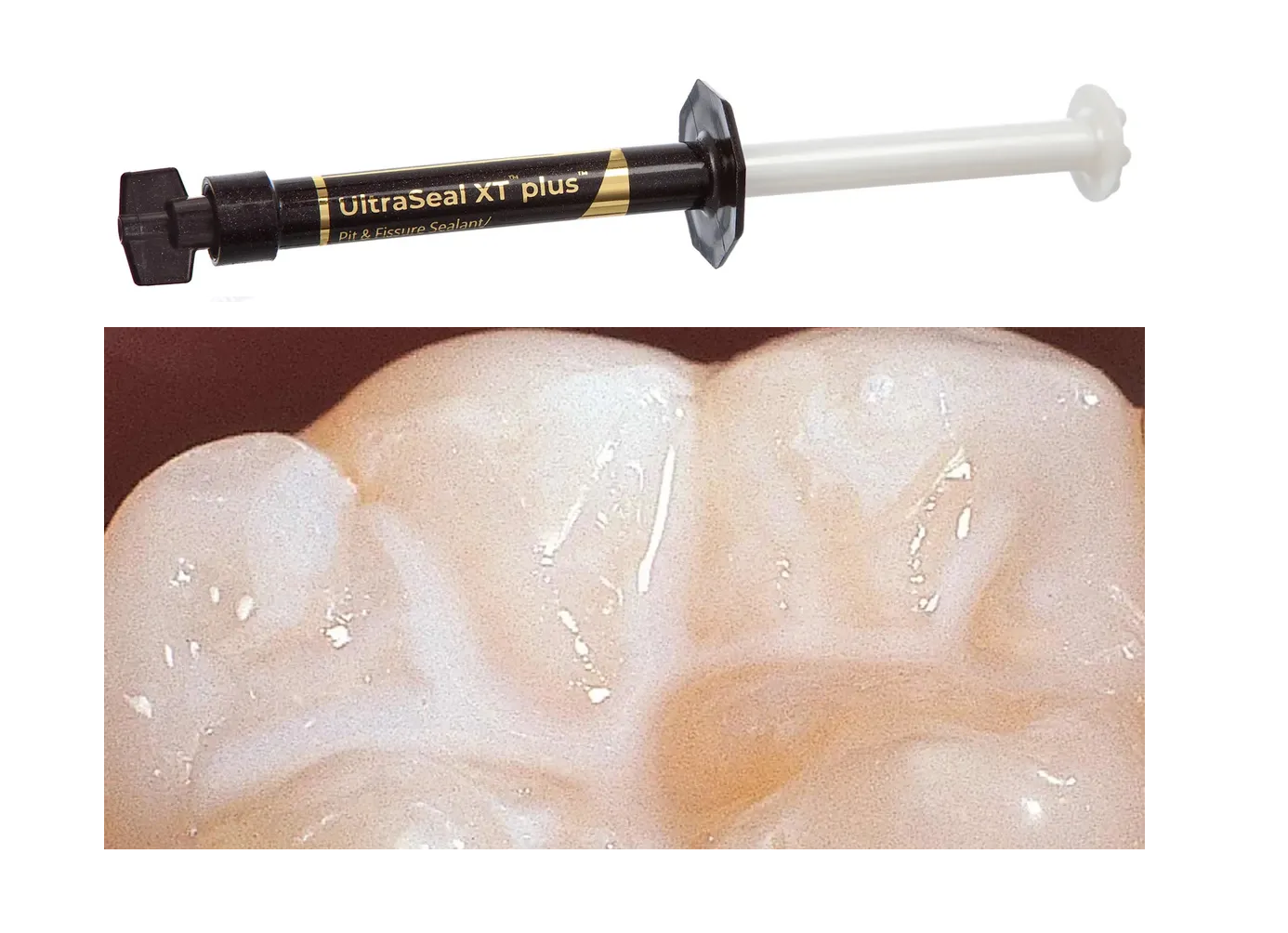 ULTRASEAL XT PLUS SELLADOR DE FOSETAS Y FISURAS | ULTRADENT